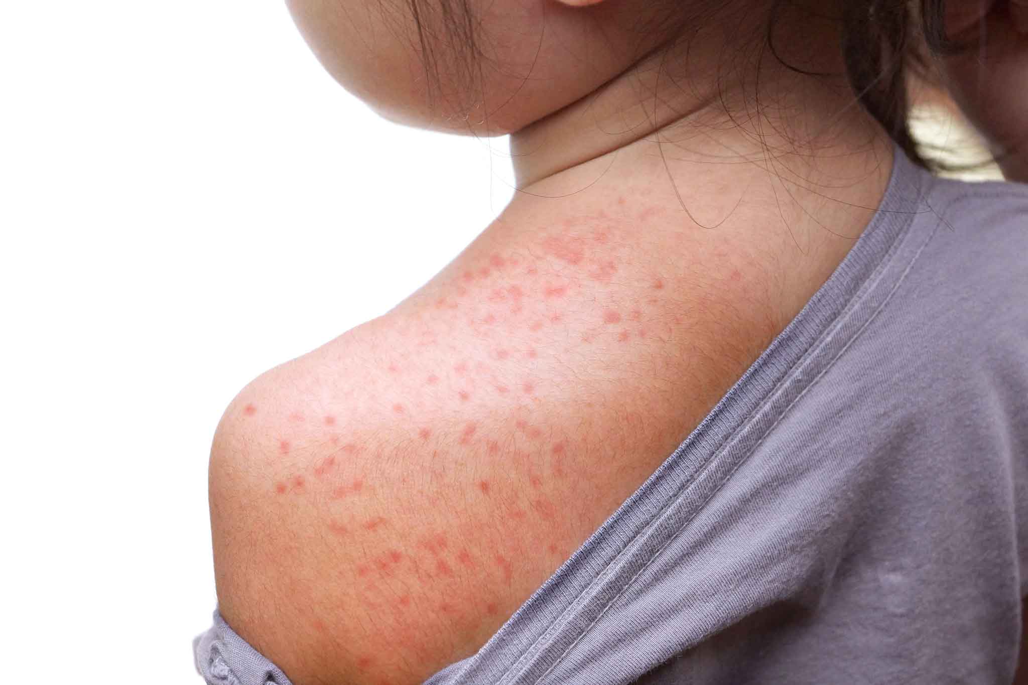 MMR and Measles - The Neaman Practice